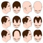 Receding Hairline in Men & Women: Causes, Signs, and Treatment