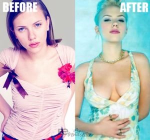 Scarlett Johansson Plastic surgery: Breast Reduction Before & After